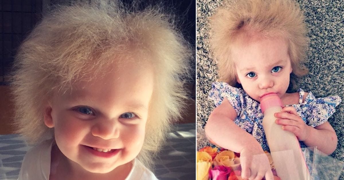 ¿Qué es el síndrome del cabello impeinable? Esta bebé lo tiene y la ...